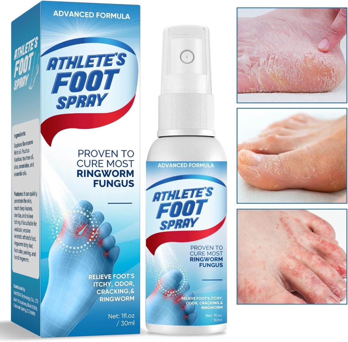 Athlete's Foot | Causes & Treatment - Ekolojist.net